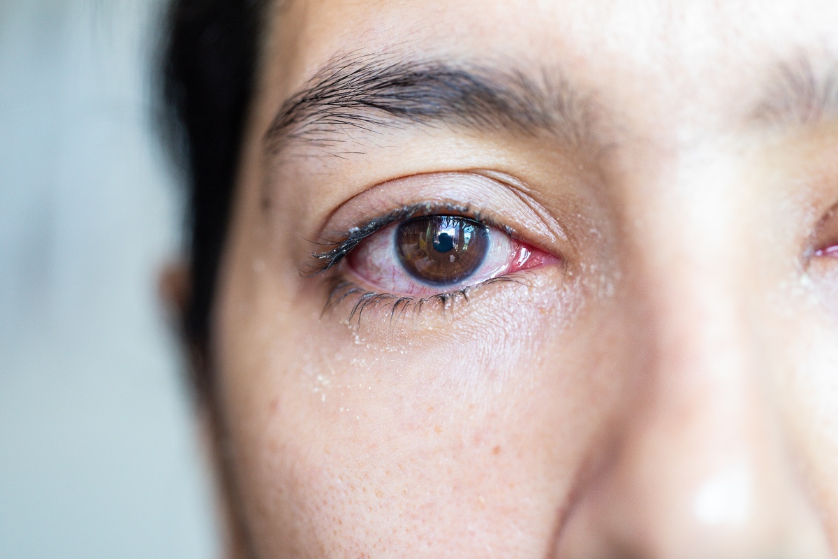 Watery Eyes: A Surprising Symptom of Dry Eye | EyeQ Optical
